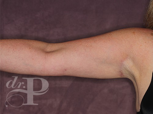 Arm Lift Gallery - Houston, TX | Dr. Christopher Patronella